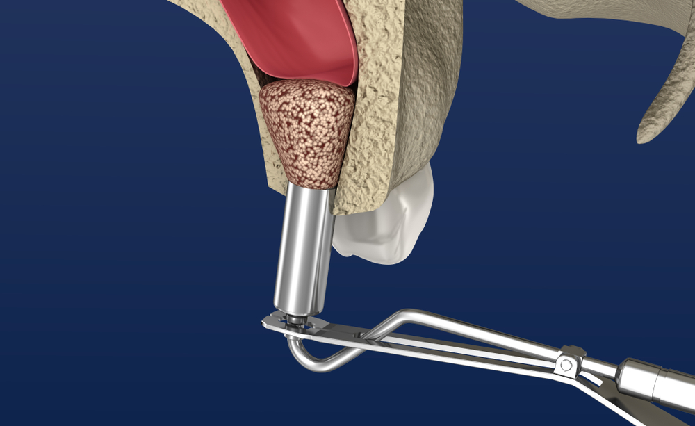 Bone Grafting: Restoring Jawbone Density for Dental Implants | E ...