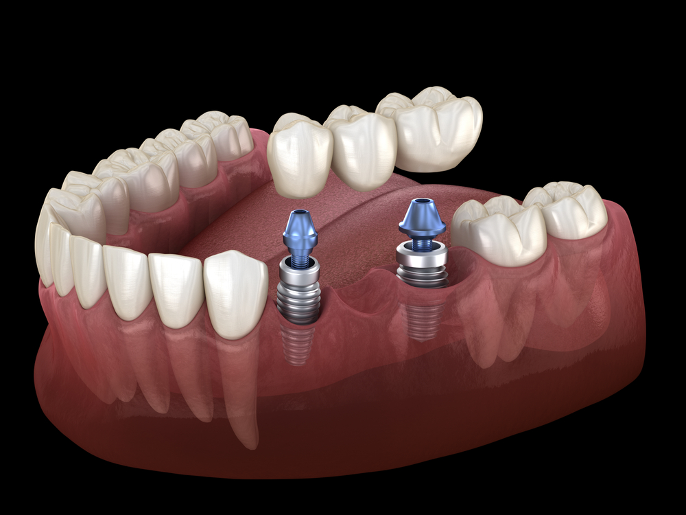 Implant-Supported Bridges Near You | SLO, CA, Implant Dentist